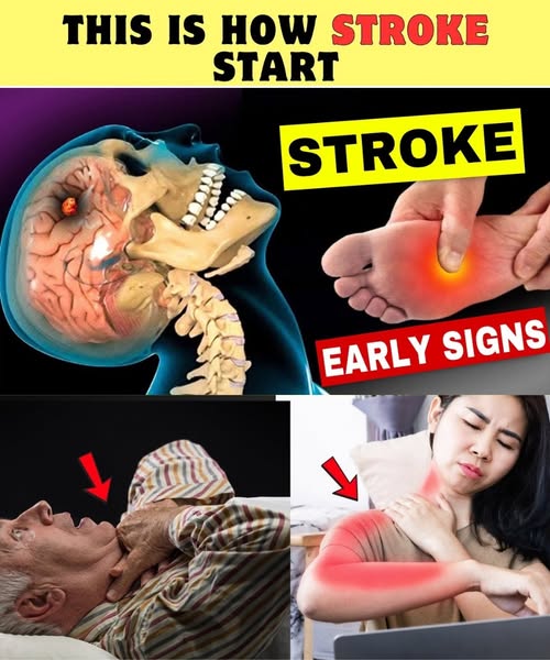 8 Warning Signs of Stroke One Month Before (And 9 Powerful Tips to ...